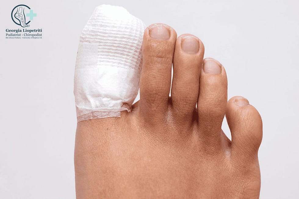 Nail Surgery - Liopetriti Podiatry